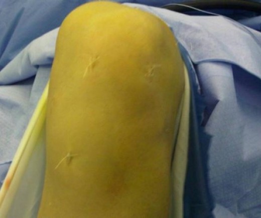 Les ligaments croisés du genou | Chirurgie orthopédique Carpentras