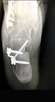 L'arthrose de cheville | Alpilles Luberon Orthopédie à Carpentras