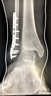 L'arthrose de cheville | Alpilles Luberon Orthopédie à Carpentras