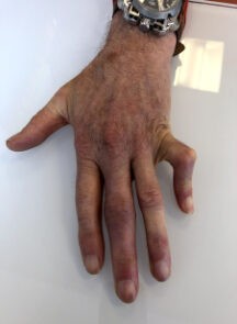 Maladie de Dupuytren | Alpilles Luberon Orthopédie de Cavaillon