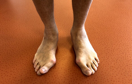 Pied plat Valgus | Alpilles Luberon Orthopédie | Chirurgien orthopédiste